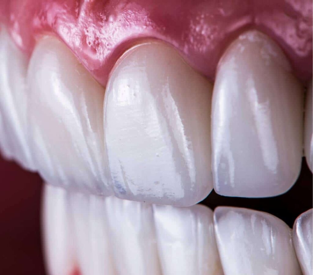 Polo Dental | porcelain-veneers